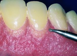 Stippling Instrumente